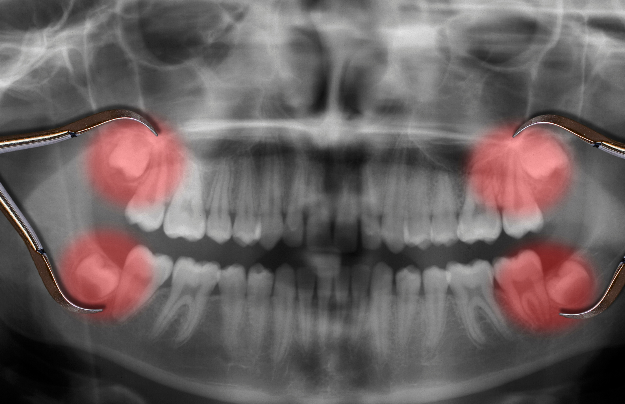 Wisdom Teeth Removal | Parklane Dental
