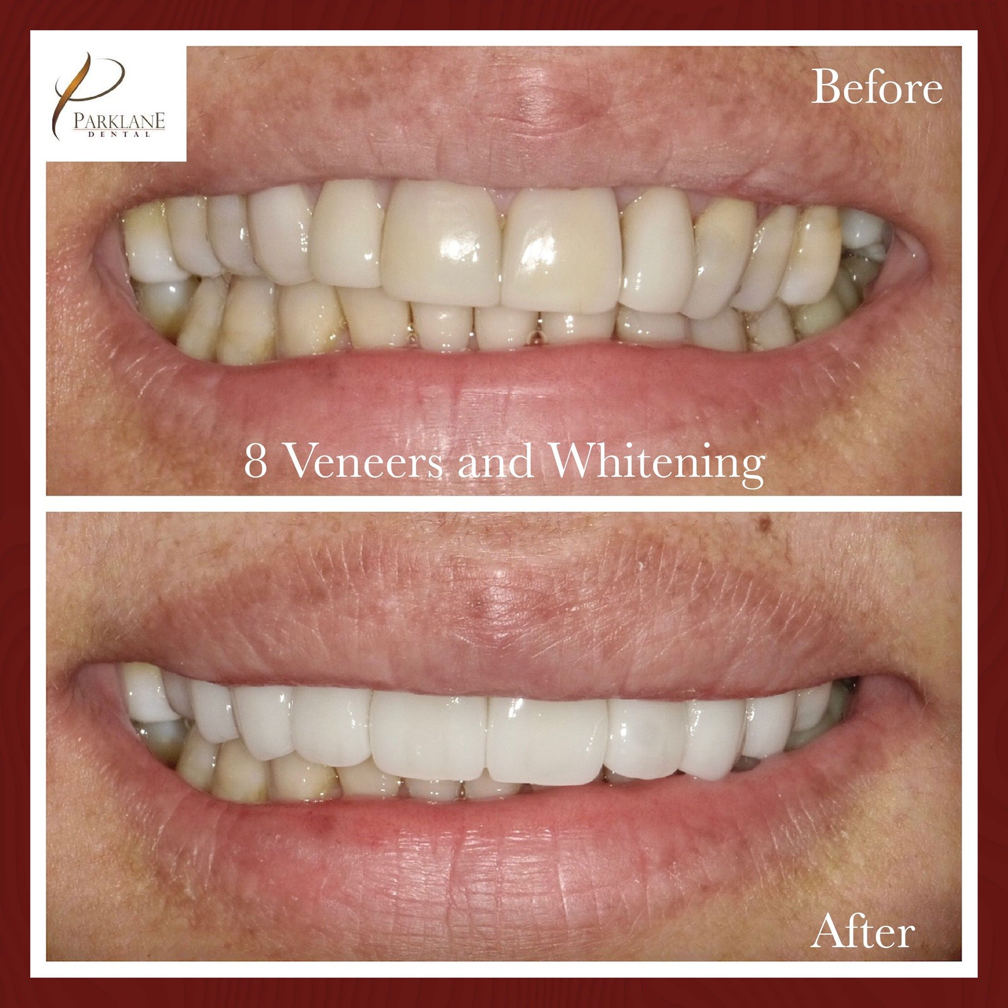 Dental Veneers Gallery | Before & After's | Parklane Dental