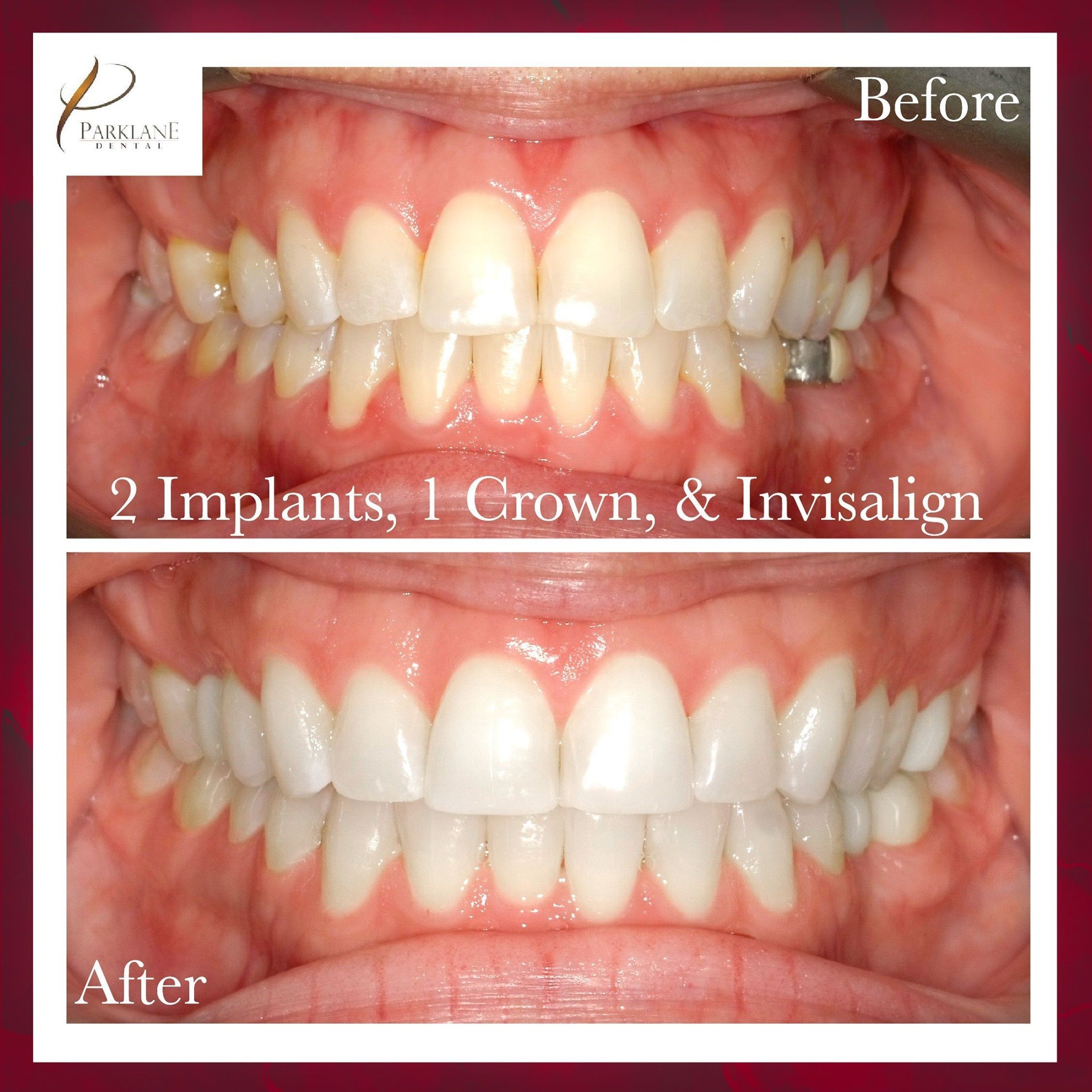 Invisalign Smile Gallery | Before & After's | Parklane Dental